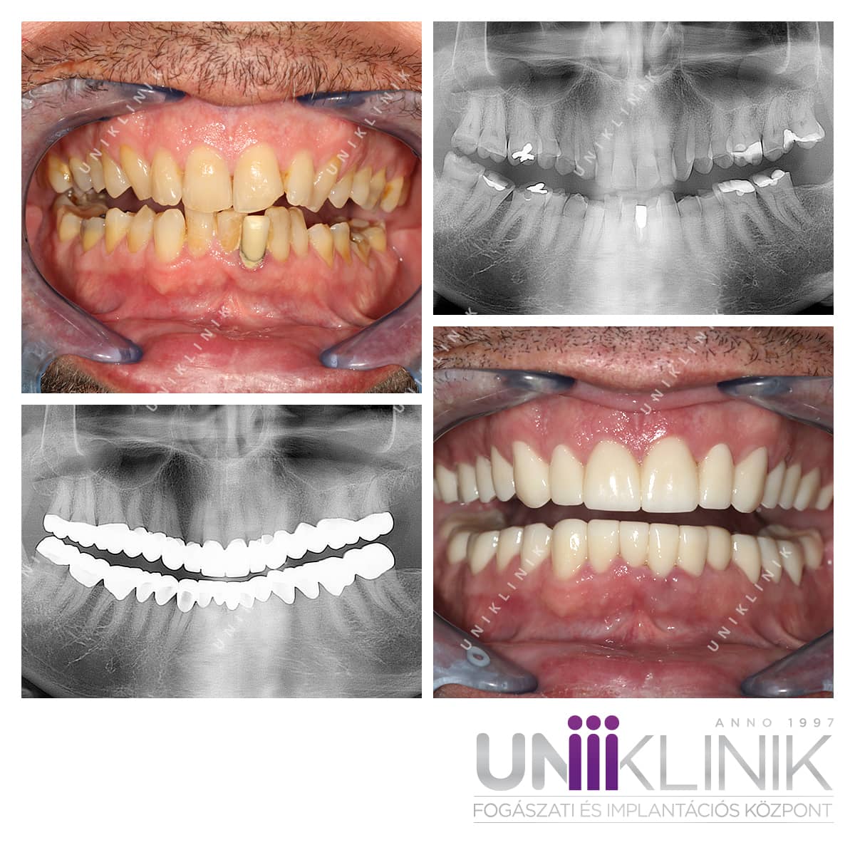Full-Contour Zirconia Crowns and Bridges for the Perfect Smile ...